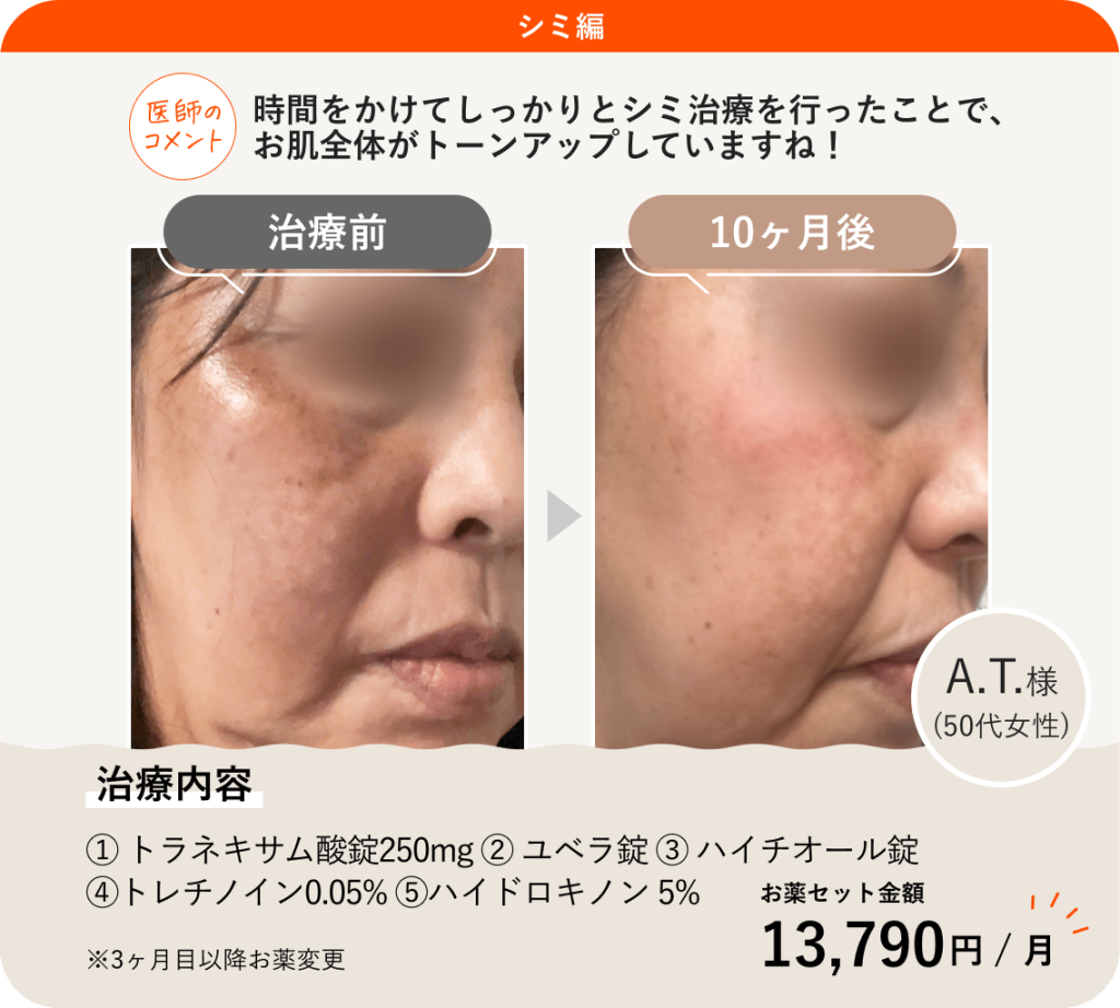 皮膚科でハイドロキノンを処方してもらうにはいくらかかる？保険適用？｜効果も詳しく解説｜ANS. magazine